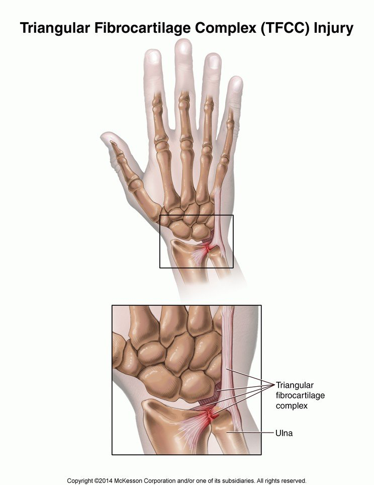 Triangular Fibrocartilage Complex Injury - Tran Plastic Surgery