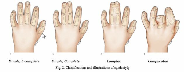 Syndactyly - Tran Plastic Surgery